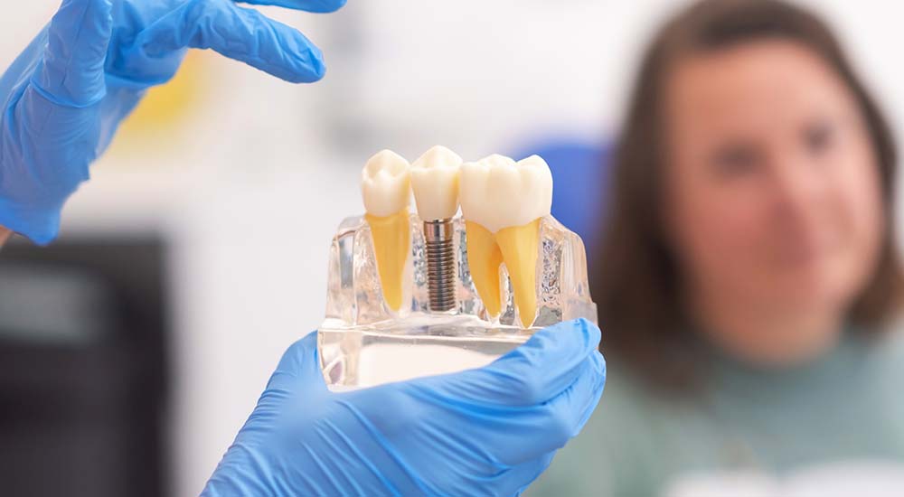 Smile Reimagined: The What, Why, and How of Dental Implants - American ...