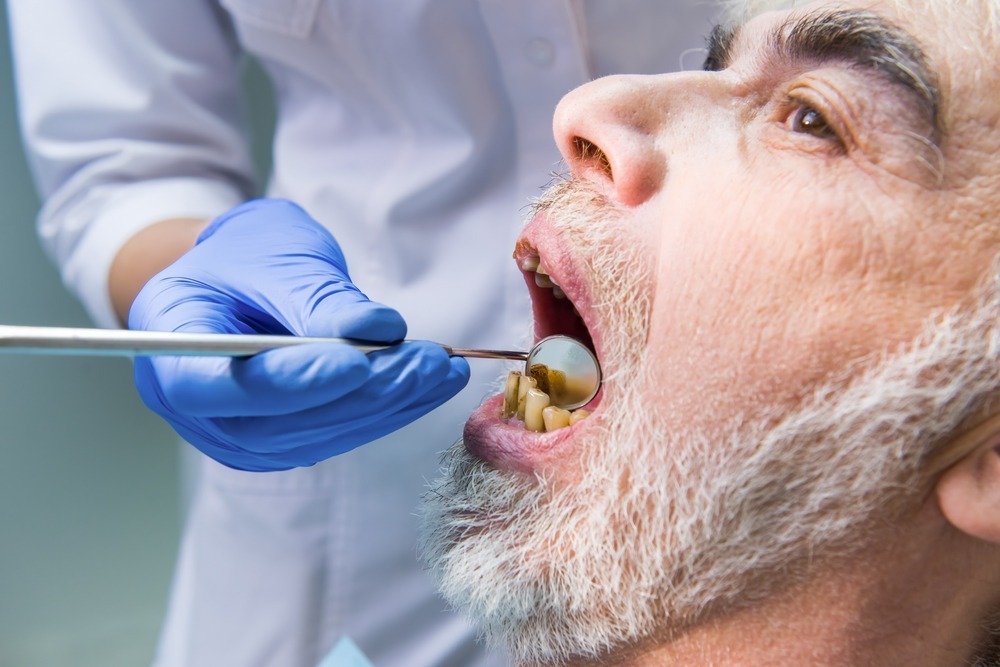 Can Poor Oral Hygiene Lead to Oral Cancer? - American Dental