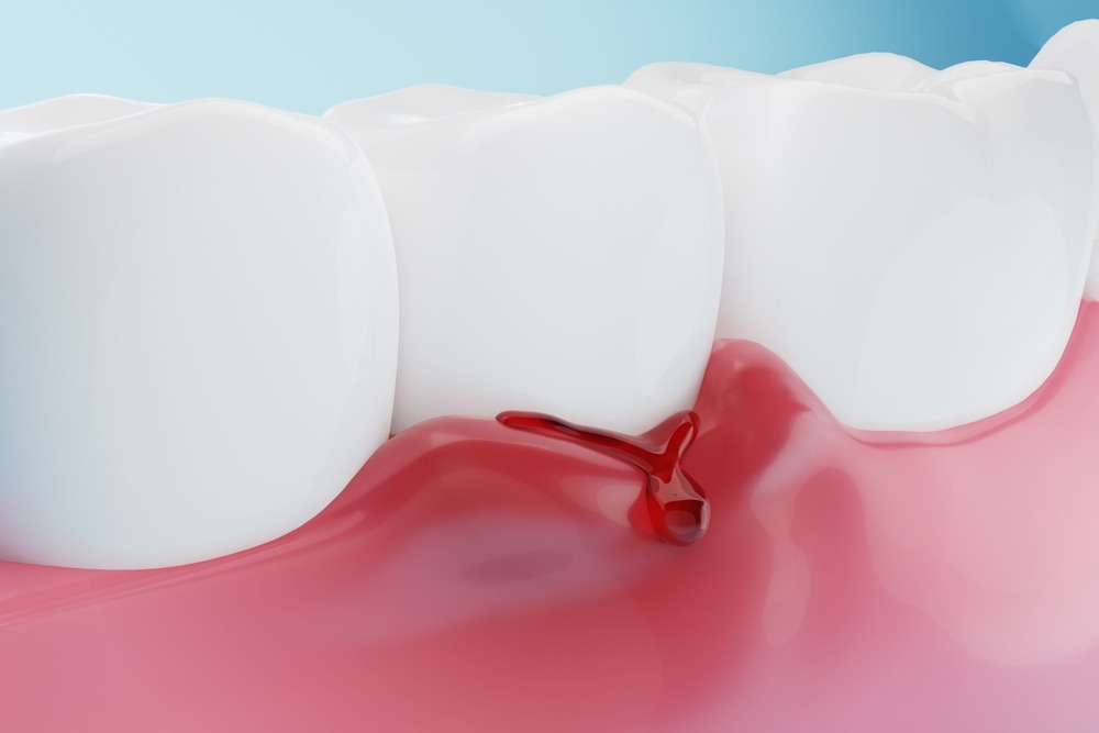 Why Are My Gums Bleeding? - American Dental